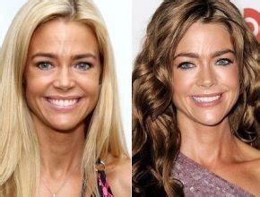 Denise Richards Before And After Plastic Surgery Celebrity Plastic