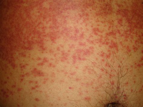 Maculopapular Rash Maculopapular Rash Causes Appearance And