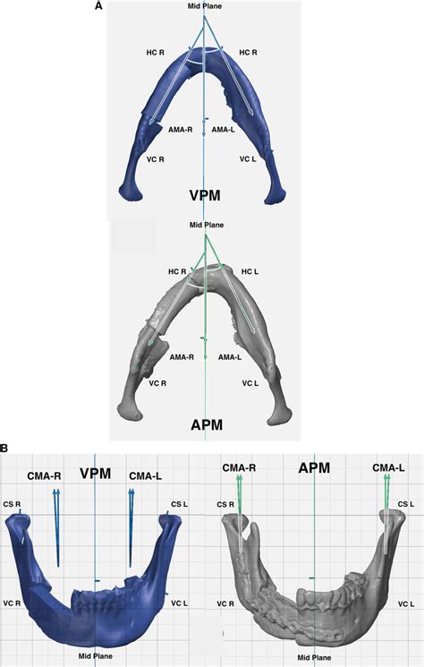 Demonstration Of Angular Mandibular Analysis A Preoperative And
