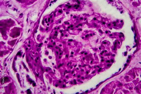 Diffuse Proliferative Glomerulonephritis Dpgn Light Micrograph Photo Under Microscope High