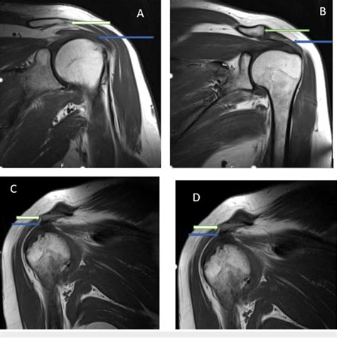 Types Of Acromial Shapes Associated With Muscle Injuries A Type I Download Scientific Diagram