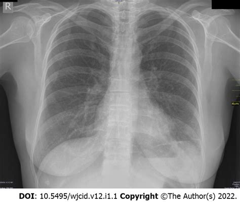 Negative Radiography Of An Asymptomatic Patient Download Scientific