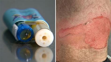 Victorian Man Scarred After Vape Exploded Inside Pocket Iget Bar