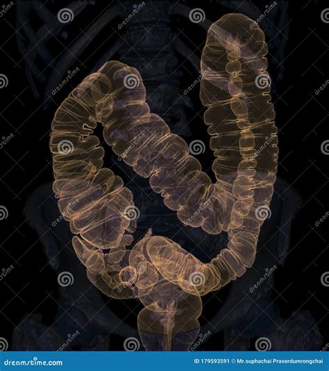 Ct Colonography 3d Rendering Image Stock Illustration Illustration Of Diverticulitis