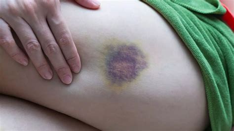 Liver Cirrhosis Subtle Signs And Symptoms You Should Know Health