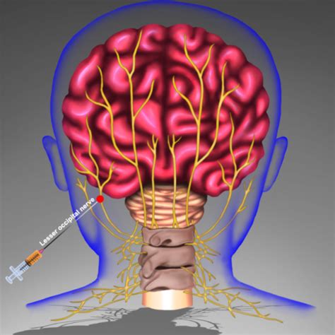 Cpt Code Occipital Nerve Block At Marcos Hines Blog
