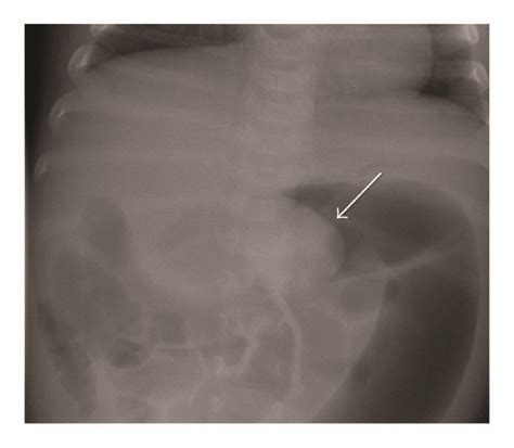 Meniscus Sign Intussusception