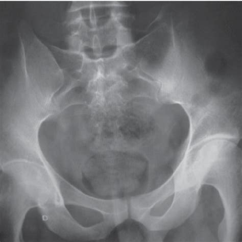 Pdf Bilateral Coxitis In Scleroderma Polymyositis Overlap Syndrome