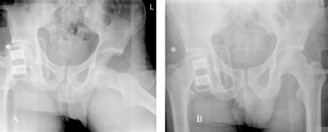 Patient 2 Anterior Obturator Dislocation A And Post Reduction Xr B