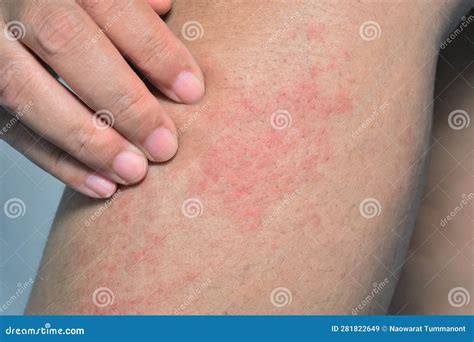 Red Allergic Rash On The Leg Skin From Atopic Dermatitis Stock Image