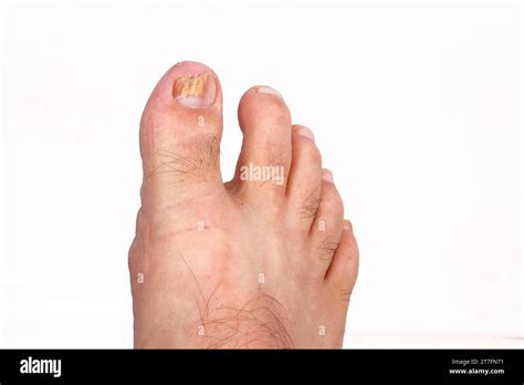Micose Nail Fungus Infection On Big Toe Fungal Infection On