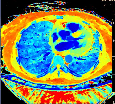 Cxr Reticulonodular Pattern Lungs
