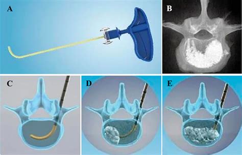 Full Article Percutaneous Curved Vertebroplasty Decrease The Risk Of