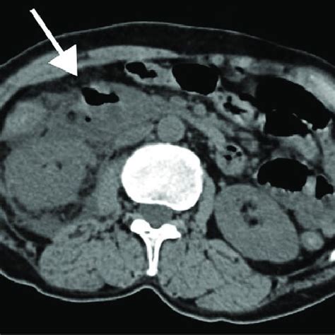 A Histological Classification Of Duodenal Polyps Download Table