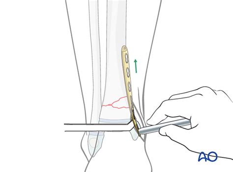 Mio Bridge Plating For Multifragmentary Complete Fracture Of The Distal