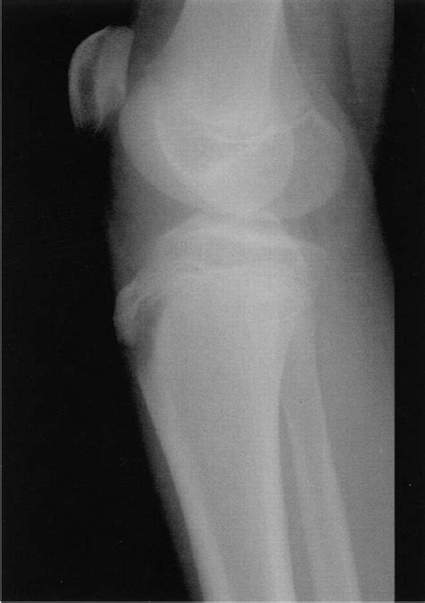 Pip Joint Dislocations Teachme Orthopedics