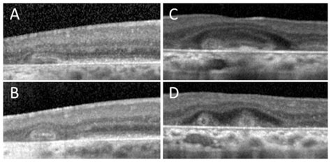 Outer Retinal Tubulation In Degenerative Retinal Disorders Abstract