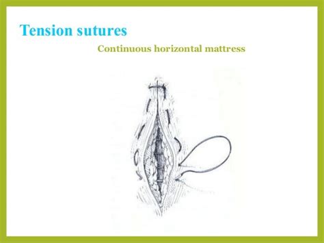 Basic Suture Patterns