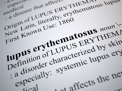 New Guidelines For Lupus Treatment From Eular Faculty Of Medicine