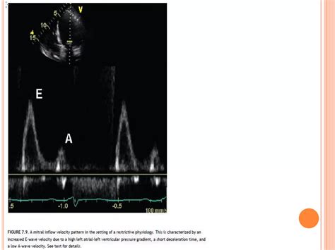 Diastolic Dysfunction 2016 Pptx Heart And Cardiovascular Diseases Diseases And Conditions