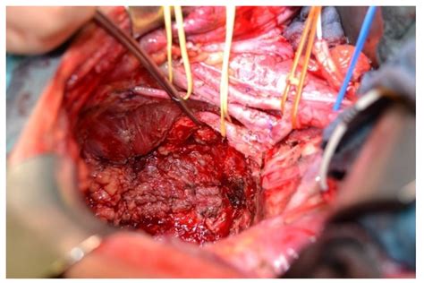 Total Pelvic Exenteration