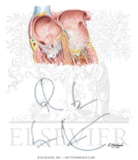 Radiofrequency Catheter Ablation