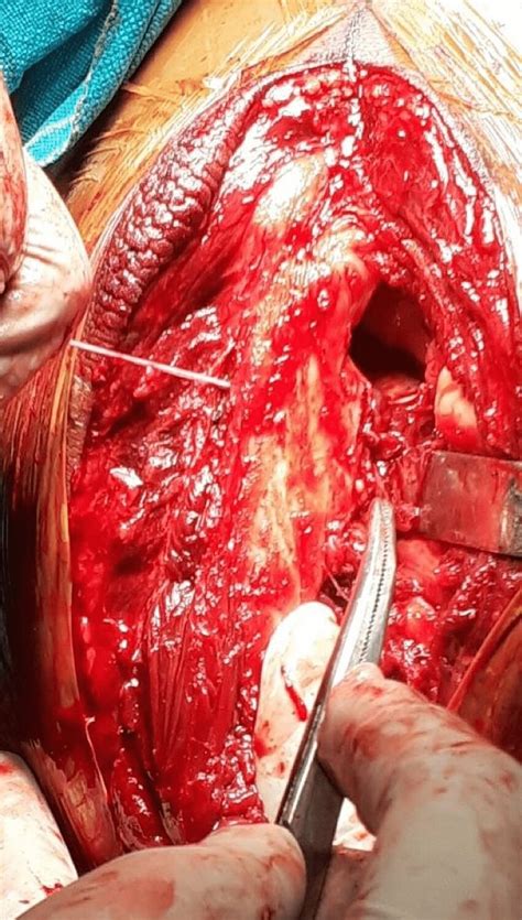 The Anterior Capsule And Coronoid Are Repaired By Taking Bites With A