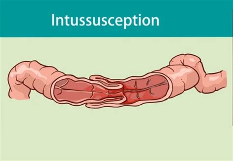 Intussusception Dr Aroon Trivedi