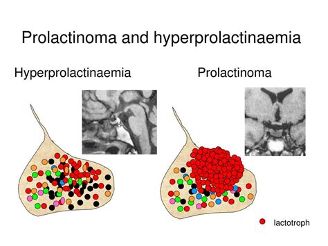 Ppt Pituitary Disease Powerpoint Presentation Free Download Id 1095541