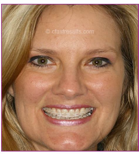 Cfast Quick Braces One Dental Care Cosmetic Dentists In Dalry