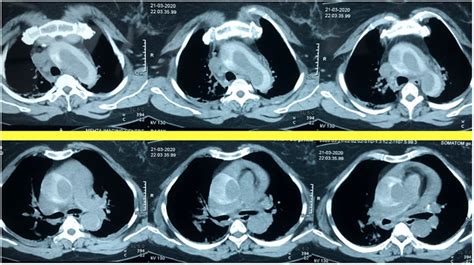 Ct Scan Showing Type‐a Aortic Dissection Ct Computed Tomography