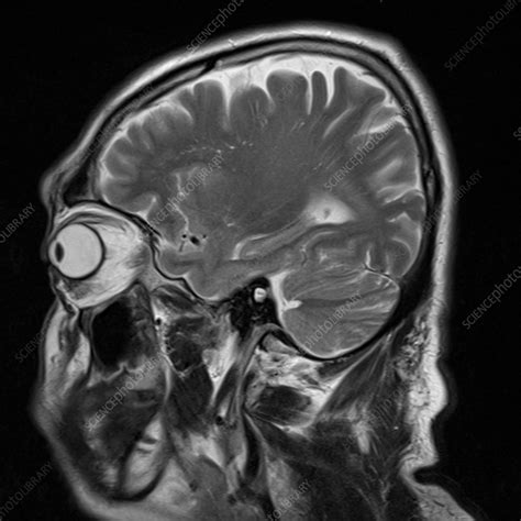 Healthy Human Brain Mri Scan Stock Image F0376630 Science Photo