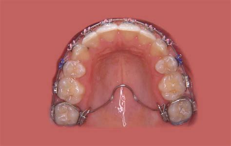 Transpalatal Arch Tpa Orthodontics By Dr Kieran Daly
