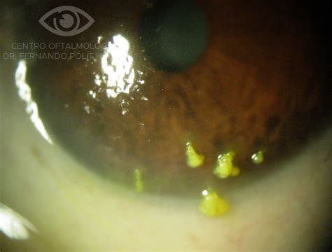 Queratitis Filamentaria Compendio De Imágenes De Oftalmología