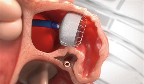 Jihan Cote On Linkedin Bostonscientific Watchmanflx Onetimeforalifetime