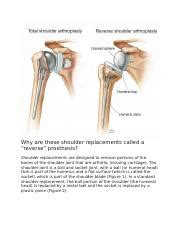 RSA Vs TSA Docx Why Are These Shoulder Replacements Called A Reverse Prosthesis Shoulder