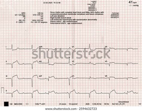 Ecg Stemi Inferior Pattern Vector Illustration Electrodiagram Show St