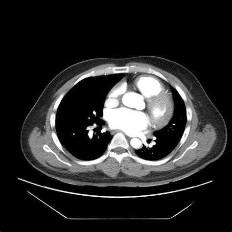 Filebowel Ischemia Mesenteric Arterial Vascular Occlusion