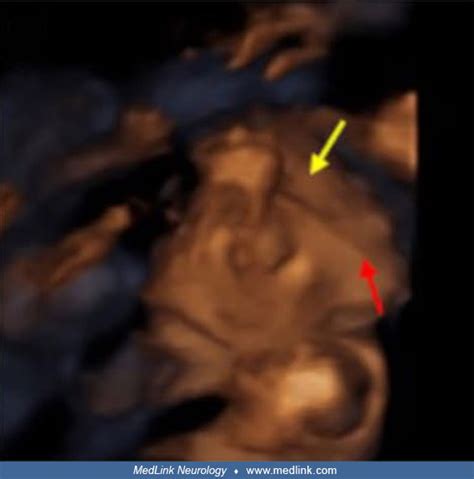 Anencephaly And Other Neural Tube Defects Medlink Neurology
