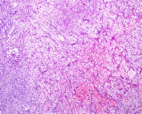Hypernephroma Light Micrograph Stock Image C060 1435 Science