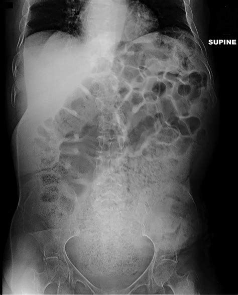 Plain Film 2 Weeks Post Operatively Shows Significant Reduction In