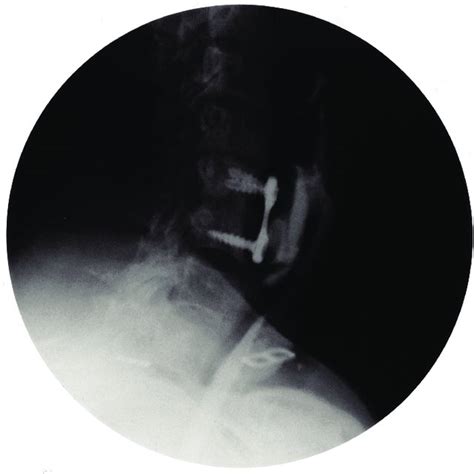 Pdf Hypopharyngeal Diverticulum Formation Following Anterior