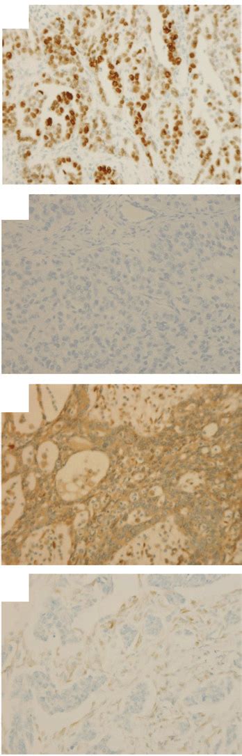 P53 And Pten Expression Analysis Using Immunohistochemistry