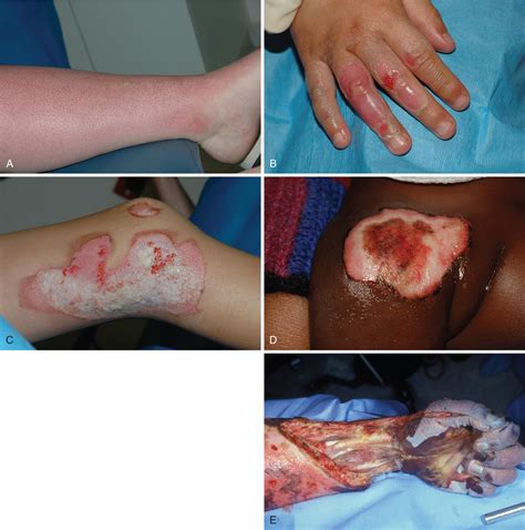 Burn Care Procedures Clinical Tree