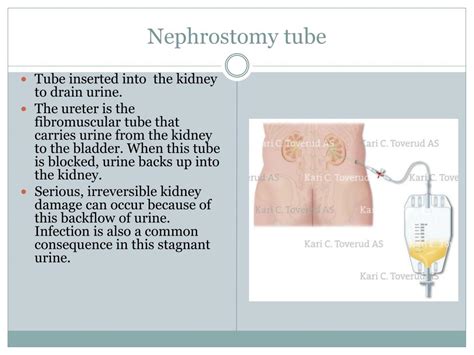 Ppt Casts Drains And Dressings Powerpoint Presentation Free