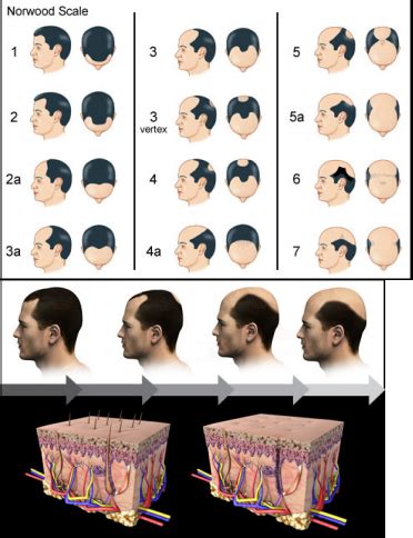Ethical Consumer Men Balding Pattern
