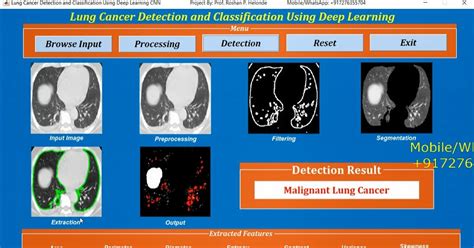 Lung Cancer Detection Using Deep Learning Matlab Project With Source