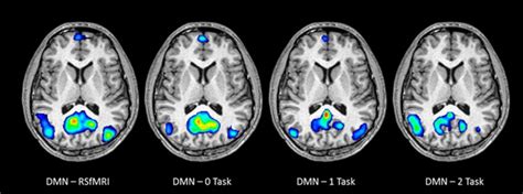 Case 2 Default Mode Network At Rest And During Performance Of
