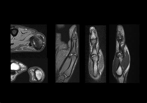 Anatomy Of The Thumb Annotated Mri E Anatomy