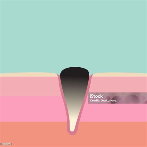 Blackhead Diagram Blackheads On Nose Treatment Before And After Vector